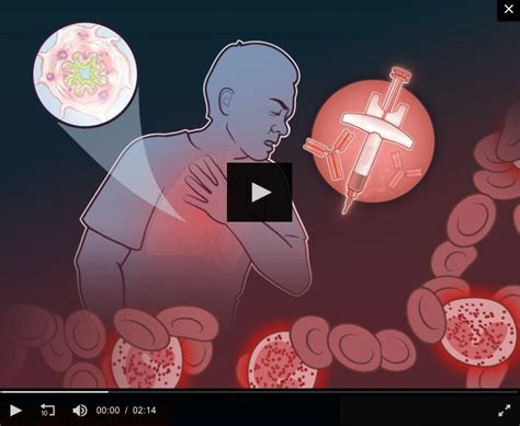 Juan Carlos Ivancevich On Linkedin Dupilumab Copd