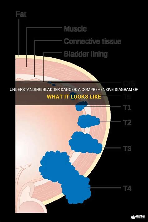 Understanding Bladder Cancer A Comprehensive Diagram Of What It Looks