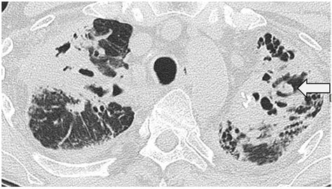 Imaging Of Pulmonary Sarcoidosis—a Review