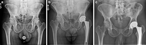 A Preoperative And B Postoperative Ap Pelvis Radiographs And C Ap