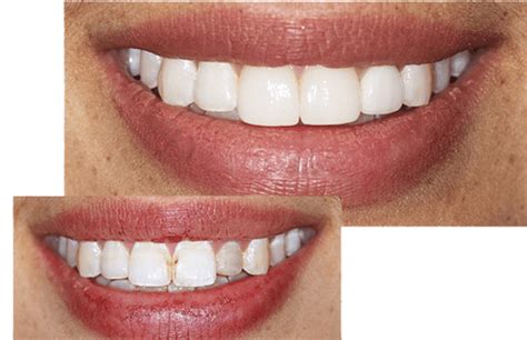 Dental Veneers Mosman Cremorne Nsw Hugh Fleming Dentistry