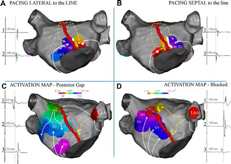 A Activation Map Pacing Lateral To The Line Close To The Mitral