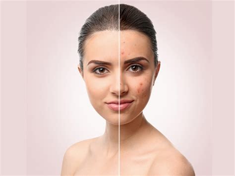 How To Banish Post Acne Marks Boldsky Com