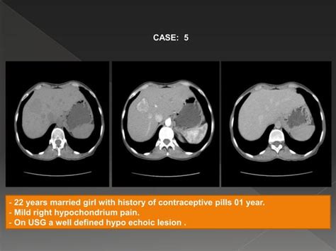 Liver Imaging Ct Scan Algorithm Pptx Lung And Respiratory Health Diseases And Conditions