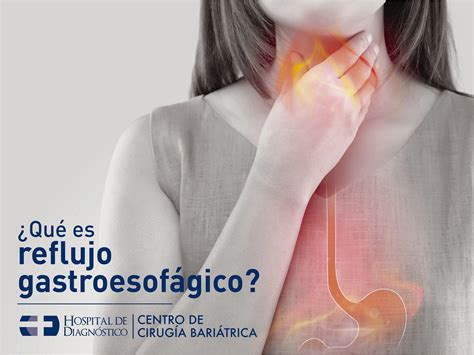 El Reflujo Gastroesofágico Centro De Cirugía Bariátrica