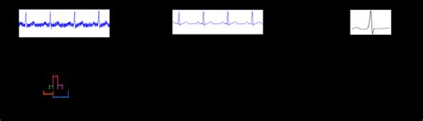 Typical Heartbeat Anomaly Detection Download Scientific Diagram