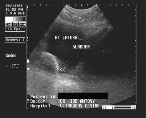 A Gallery Of High Resolution Ultrasound Color Doppler And 3d Images Urinary Bladder