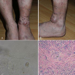 Clinical And Microscopy Presentation Of Patient A Multiple Nodules Download Scientific