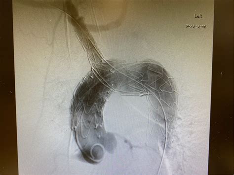 Completion Aortogram Postdeployment Showing Patent Coronaries No