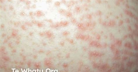 Pemphigoid Gestationis 00009 Image