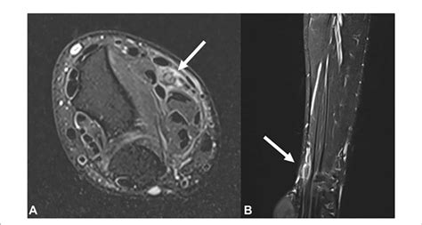 Figure Magnetic Resonance Imaging Findings Of The Right Median Nerve