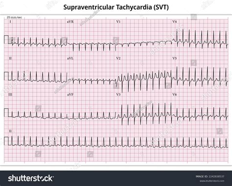 Ecg Supraventricular Tachycardia 12 Leads Ecg Stock Vector Royalty