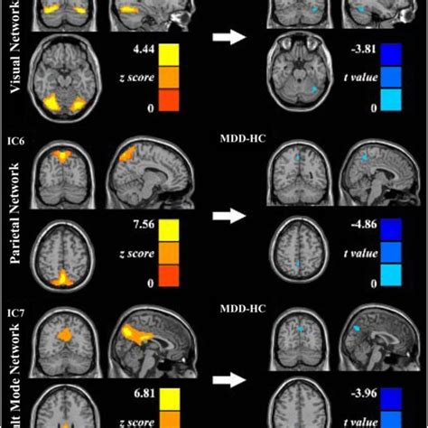 The Differences In Functional Synchronization Between Major Depressive Download Scientific