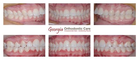 Class Ii Division 1 Teeth