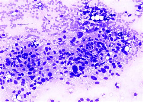 Pleomorphic Liposarcoma This Aggregate Shows Obvious Anisonucleosis Download Scientific