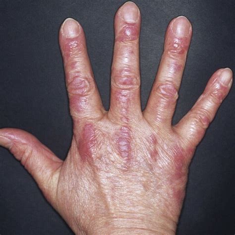 Gottrons Papules