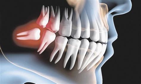 Cirurgia Terceiro Molar Dra Lidiana Toledo
