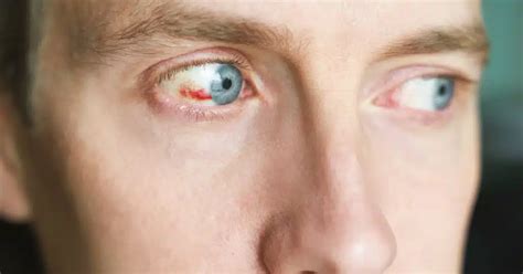 Episcleritis Vs Scleritis Understanding The Differences And Similarities