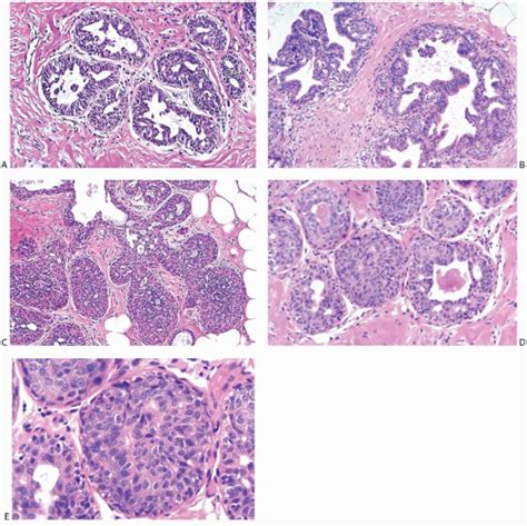 Ductal Hyperplasia Usual And Atypical Basicmedical Key