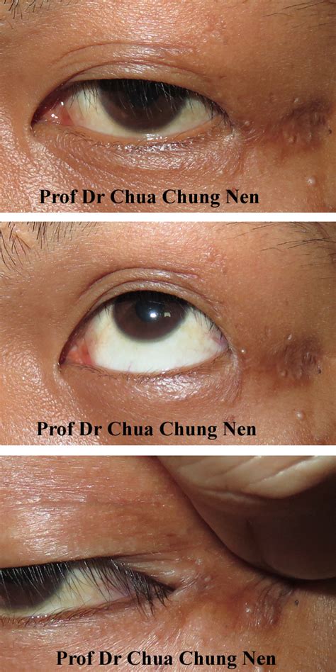Eyelid Surgery by Prof Dr CN CHUA 蔡鐘能 Repair of a Shortened Eye with