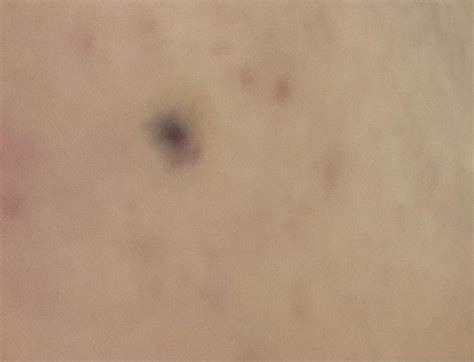 여드름 염증주사 후 지식in