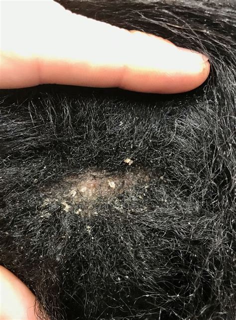 How To Treat Dry Flaky Scalpblack Hair At Jenny Abate Blog
