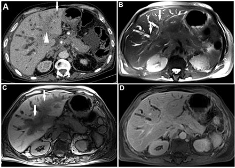 A Post Contrast Portal Venous Phase Axial Ct Image Demonstrating