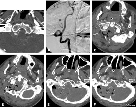 Evaluation Of Ec Ic Bypass Grafts Using Ct Angiography Barrow Neurological Institute