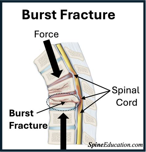 Lumbar Burst Fracture Spine Education