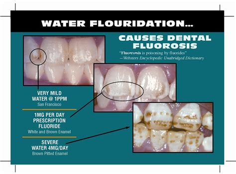 What Causes Fluoride Stains On Teeth At Charley Smith Blog