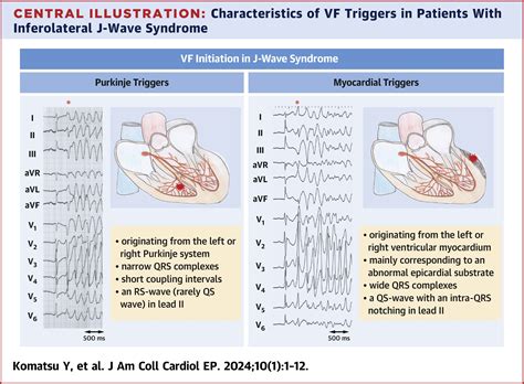 Triggers Of Ventricular Fibrillation In Patients With Inferolateral J