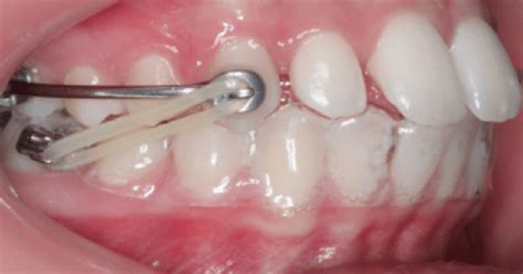 Types Of Orthodontic Appliances Lakewood Braces Brodsky Orthodontics