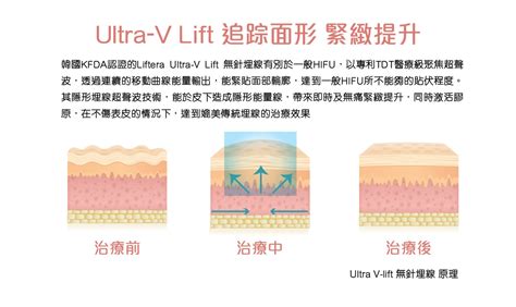 Liftera V 無針埋線 Skin And Co