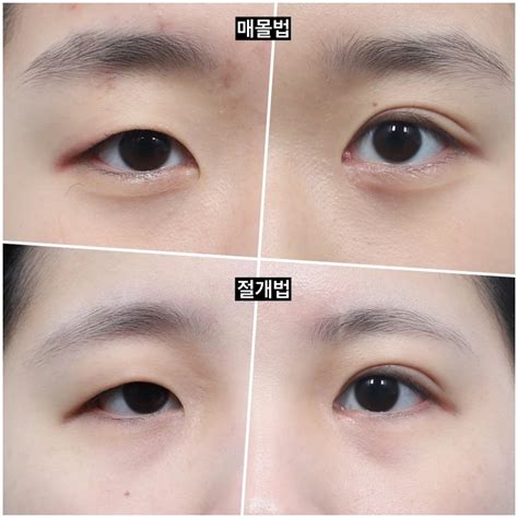 쌍꺼풀 수술 매몰법 Vs 절개법 내게 맞는 방법은 안면거상 눈수술 전문 강남 성형외과