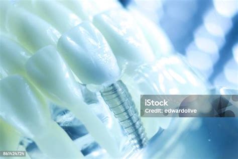 치과 입 치아 모델 근접 촬영 고립에서 치과 티타늄 미적 교정 치아 이식 강철에 대한 스톡 사진 및 기타 이미지 강철 건강관리와 의술 건강한 생활방식 Istock