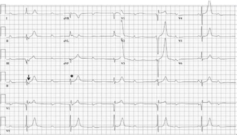 2 Conduction Disturbances Sinus Node Disease Sick Sinus Syndrome Av Conduction Disturbances