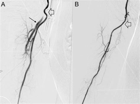 Navigating Radial Artery Loops In Neurointerventions Journal Of