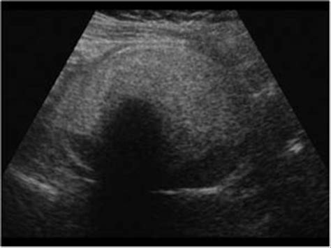 Gynaecology 32 Adnexa Case 322 Dermoid Cysts Cystic Teratomas