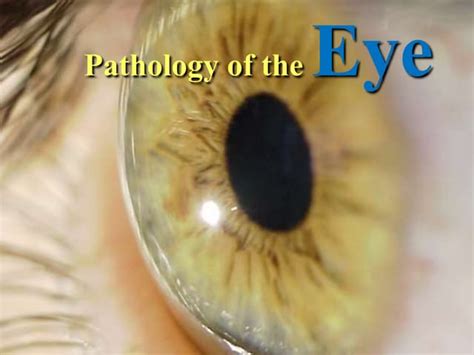 Ch29 Eye Pathology Of Eyechapter 19 Ppt