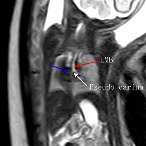 Fetal Mri Ssfse Shows That The Left And Right Lung Volumes And The Download Scientific Diagram