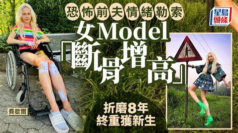 斷骨增高14厘米︱德女模為取悅前度煎熬8年 「打斷脛骨安裝伸縮器」