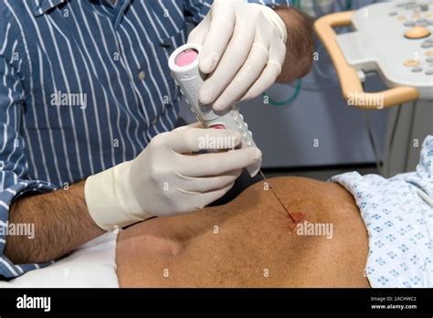 Percutaneous Liver Biopsy Doctor Using A Long Needle Inserted Through A Patients Abdomen In