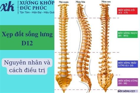 Xẹp đốt sống lưng D12 là gì Triệu chứng và nguyên nhân gây bệnh