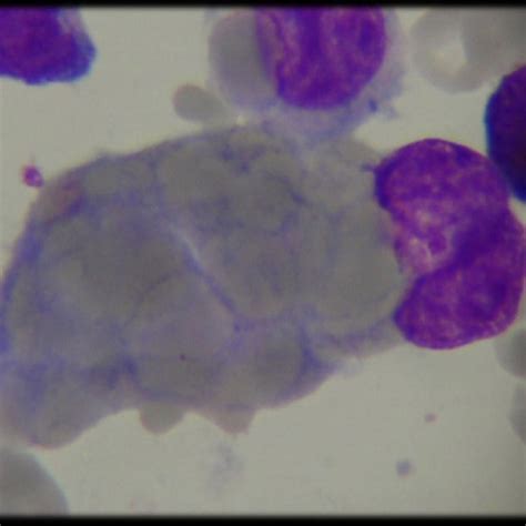Bone Marrow Aspiration Demonstrating Hemophagocytosis In Patient P4