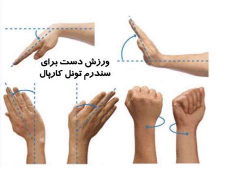 ورزشهای سندروم تونل کارپ ، روش های درمان تنگی کانال مچ دست دکتر نجفی