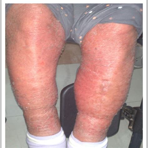 Diffuse Infiltrating Erythroderma Of The Lower Extremities Download Scientific Diagram
