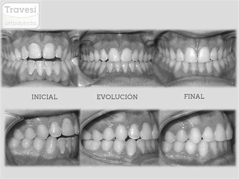 Invisalign antes y después Galería con imágenes y fotografía
