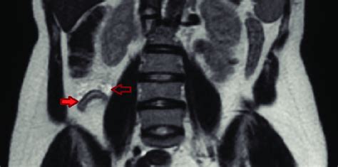 Dilated Appendix Filled Arrow And Periappendicular Fluid Empty