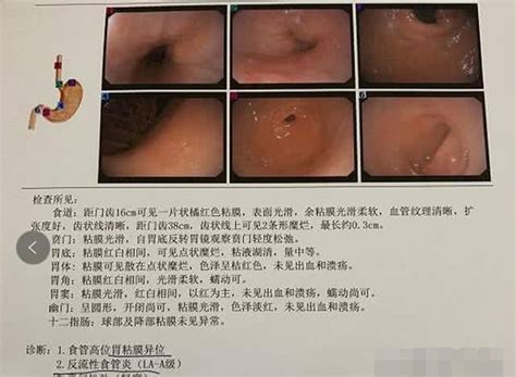 胃食管反流胃镜食用正常第2页大山谷图库