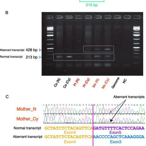 Assessment Of Nmd Of The Tandem Duplication Allele In Patient 1 And Her Download Scientific